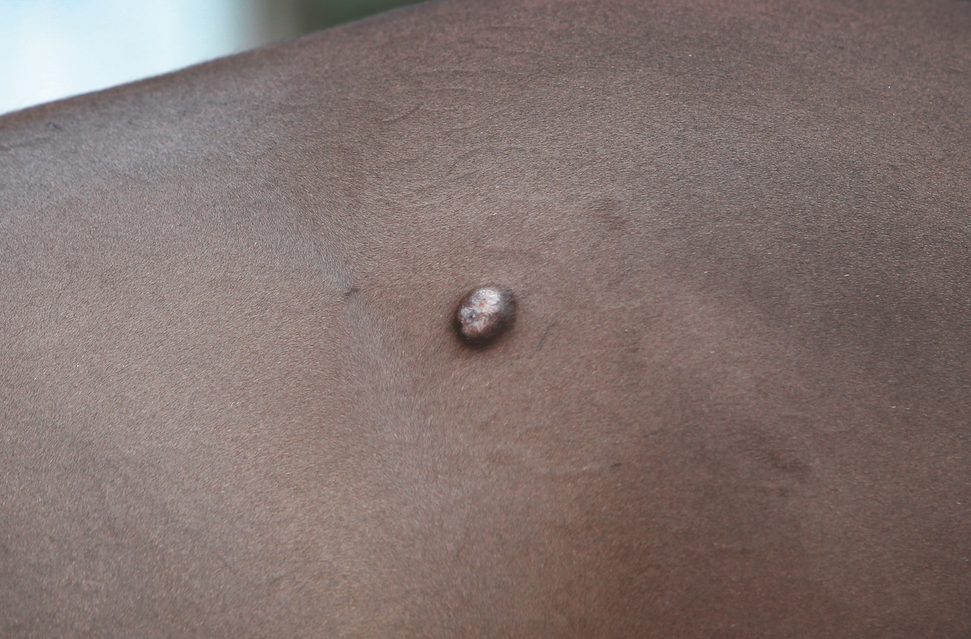 Cream or surgery? Equine vet explains treatment options for a sarcoid ...